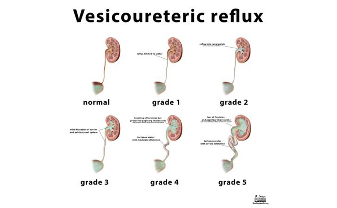Vesicoureteric Junction Calculus Treatment Symptoms Vesicoureteric Junction Calculus Treatment Symptoms